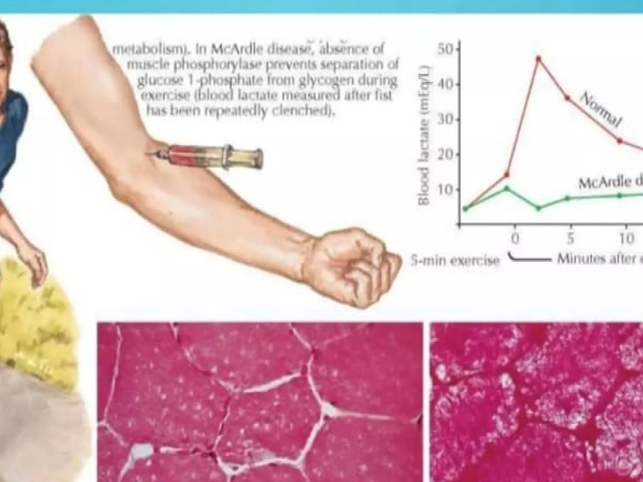GSD NEW one classification , diagnosis & manaement.pptx