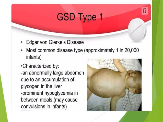 GSD NEW one classification , diagnosis & manaement.pptx