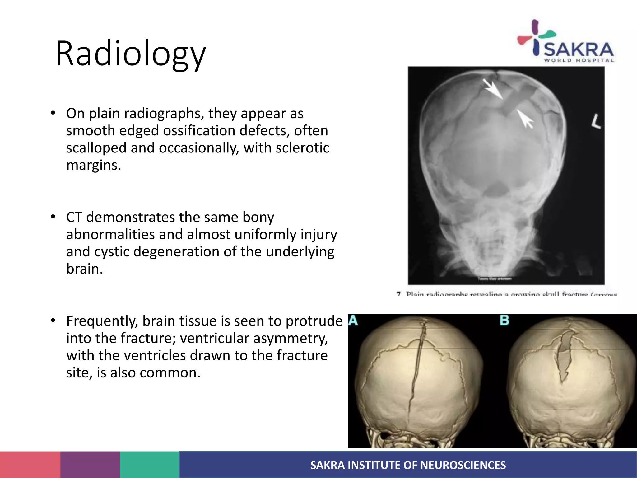Growing skull fracture | PPTX