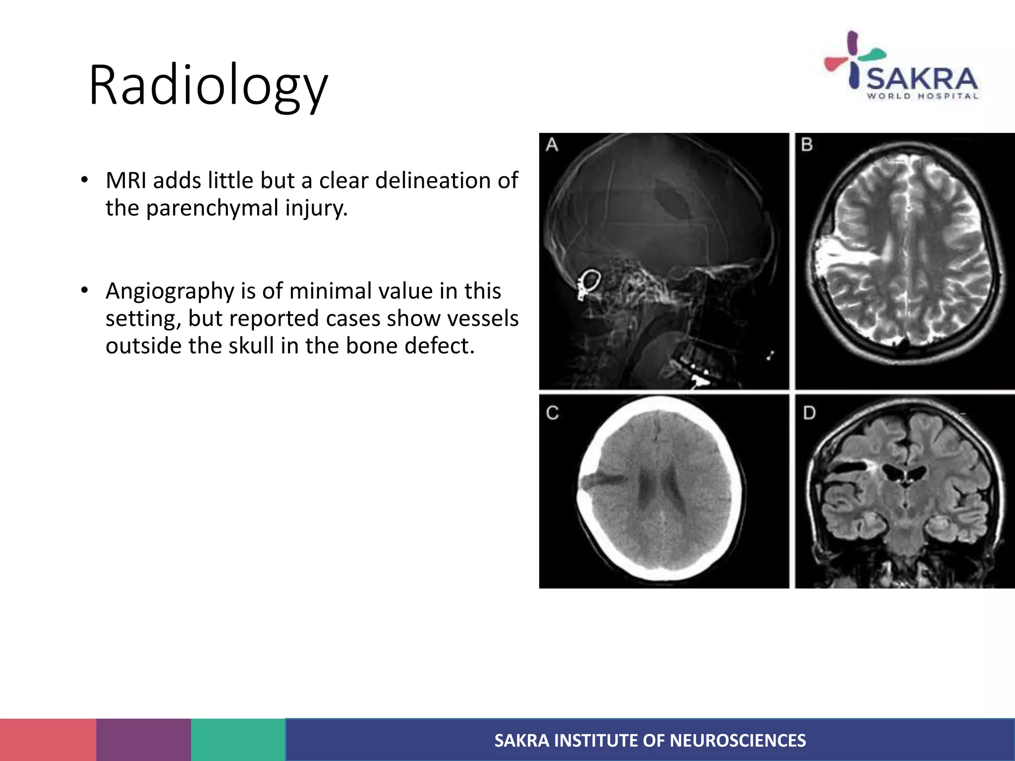Growing skull fracture | PPTX
