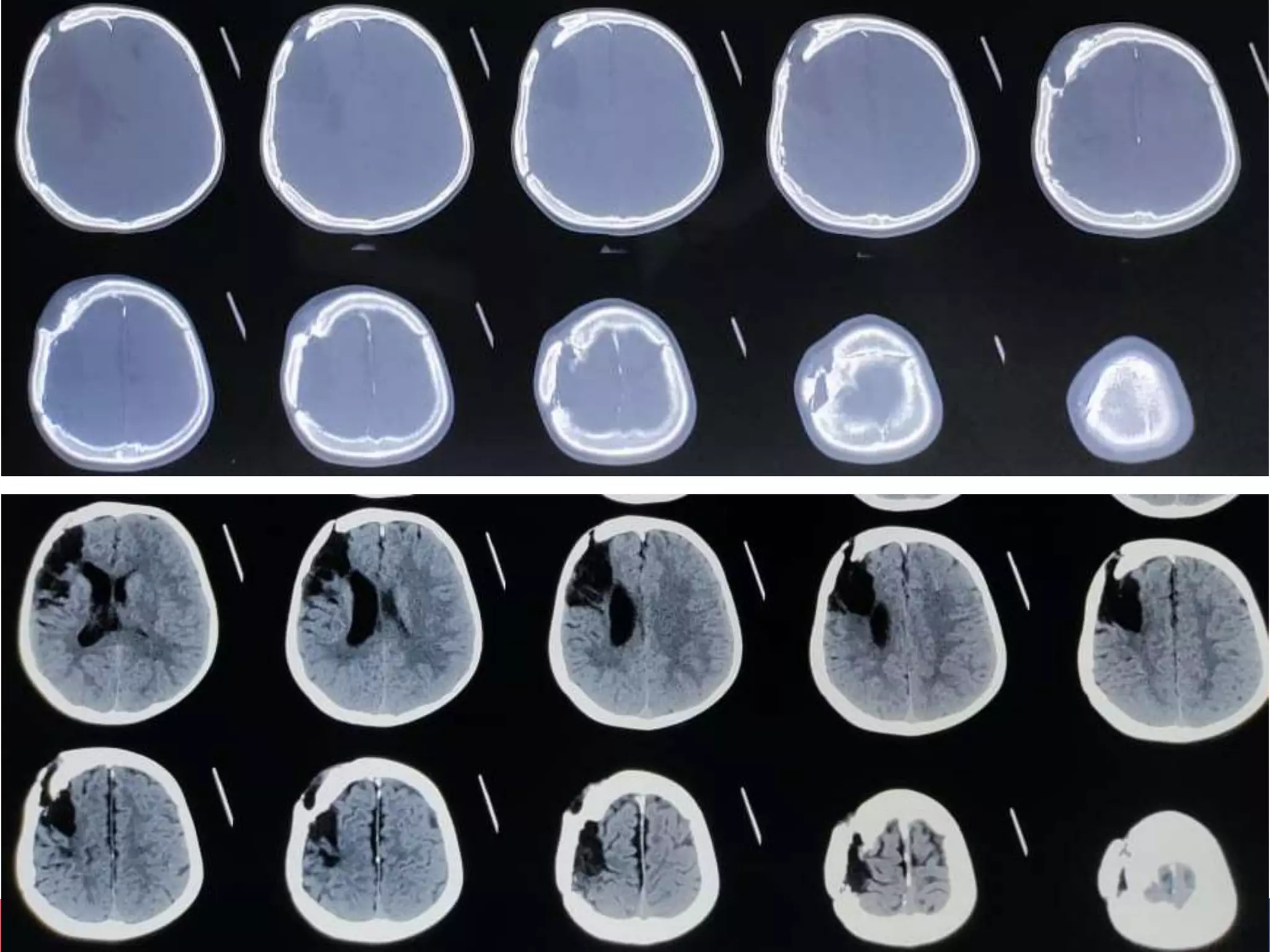 Growing skull fracture | PPTX