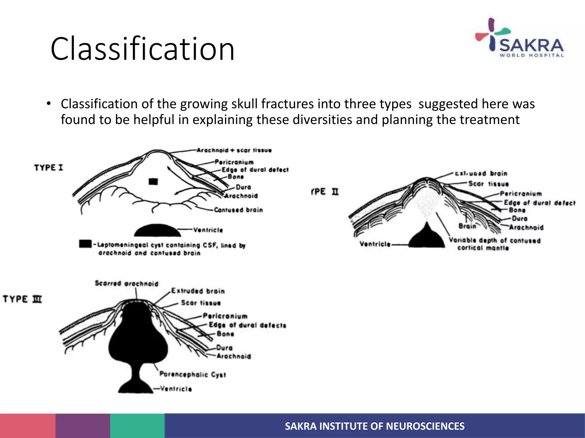 Growing skull fracture | PPTX