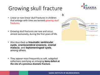 Growing skull fracture | PPTX