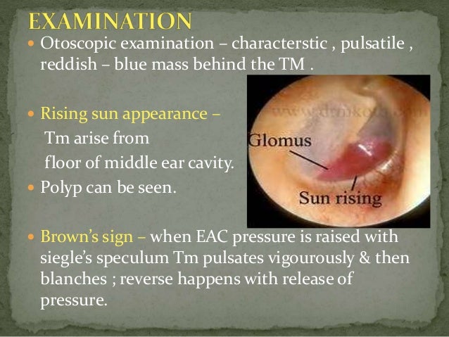 Glomus Tumor Ear