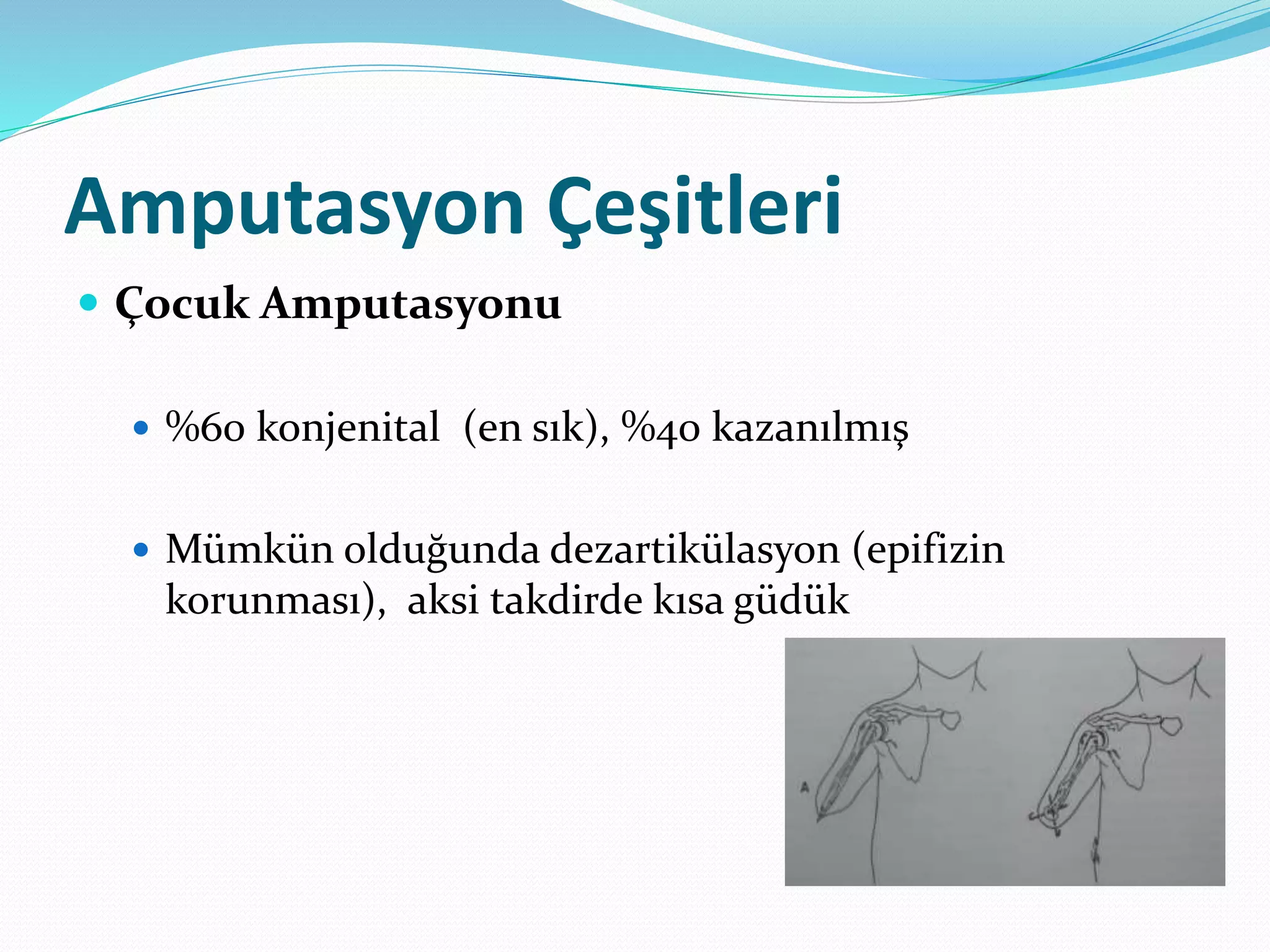 amputasyonlar | PPTX