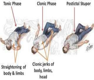 GENERALISED TONIC CLONIC SEIZURES | PPTX