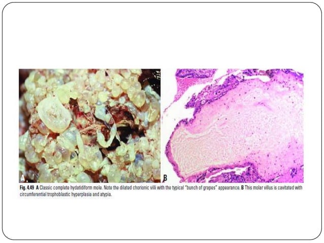 Gestational trophoblastic disease | PPTX | Pregnancy | Reproductive Health