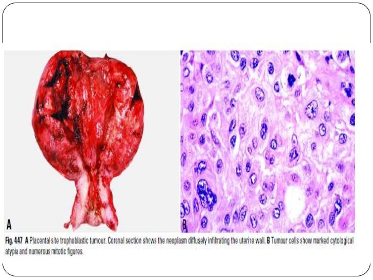 Gestational trophoblastic disease