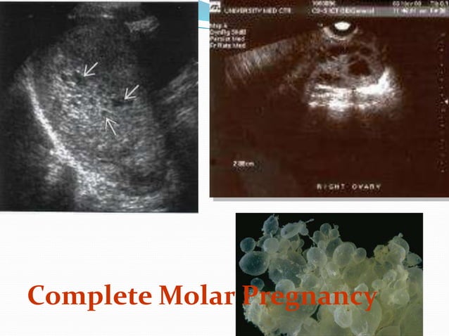 Gestational trophoblastic diseases | PPTX | Pregnancy | Reproductive Health