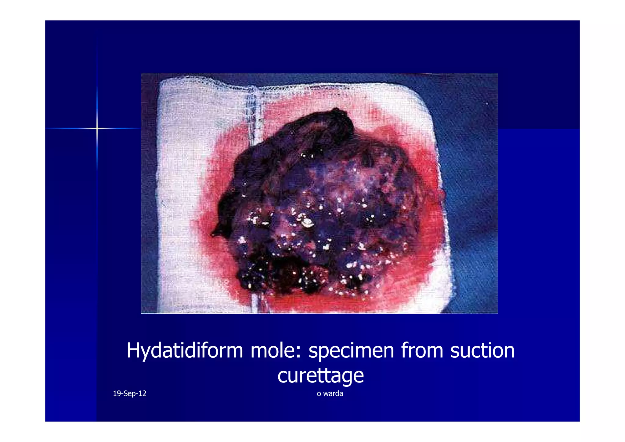 gestational trophoblastic disease GTD | PDF