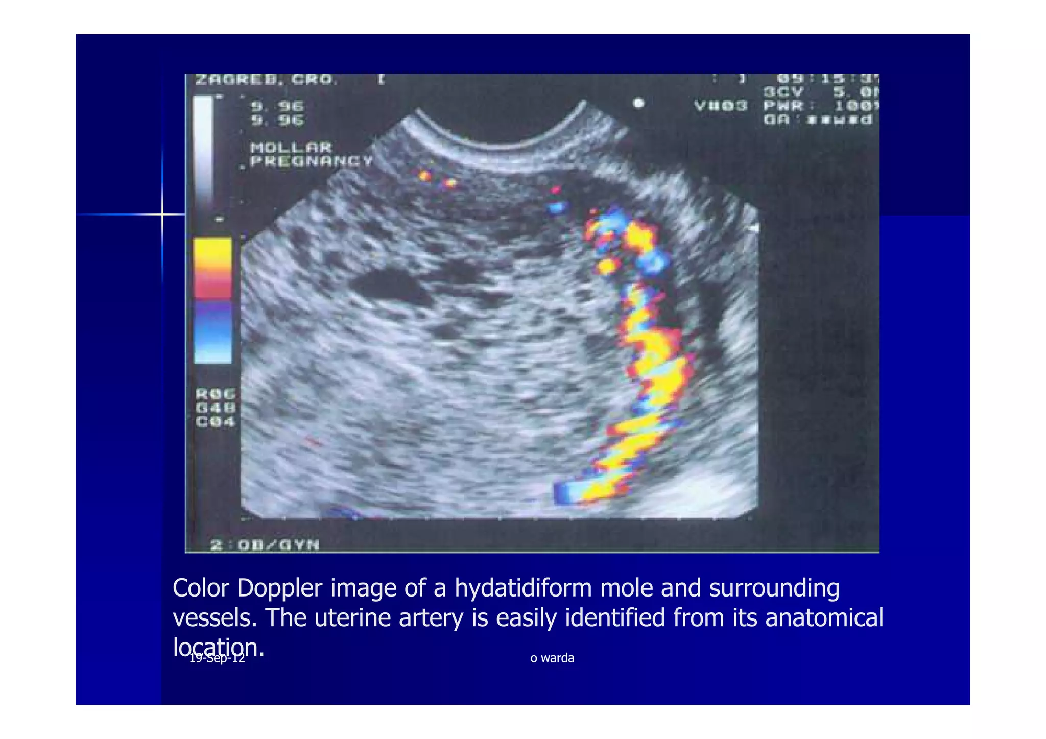gestational trophoblastic disease GTD | PDF