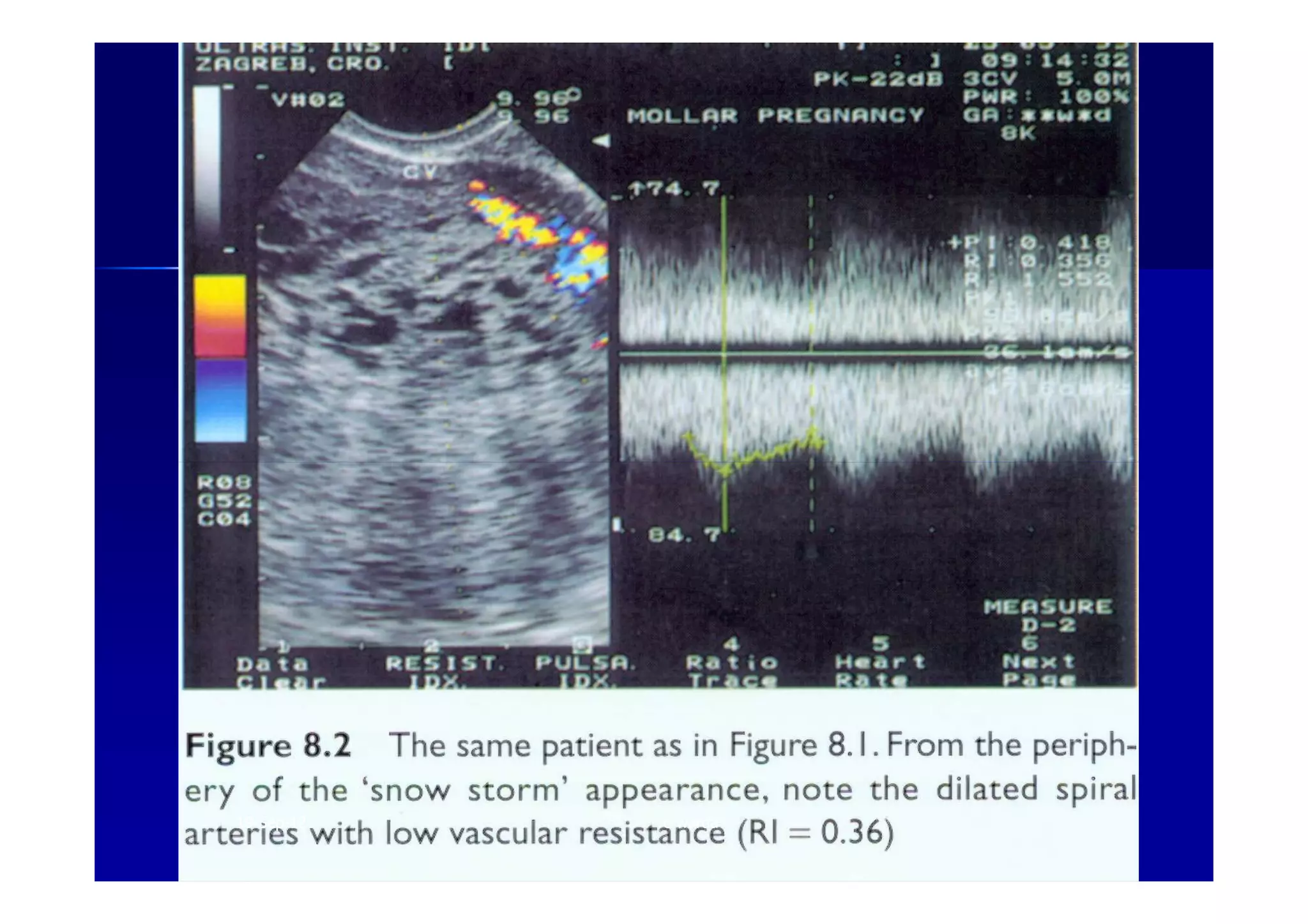 gestational trophoblastic disease GTD | PDF