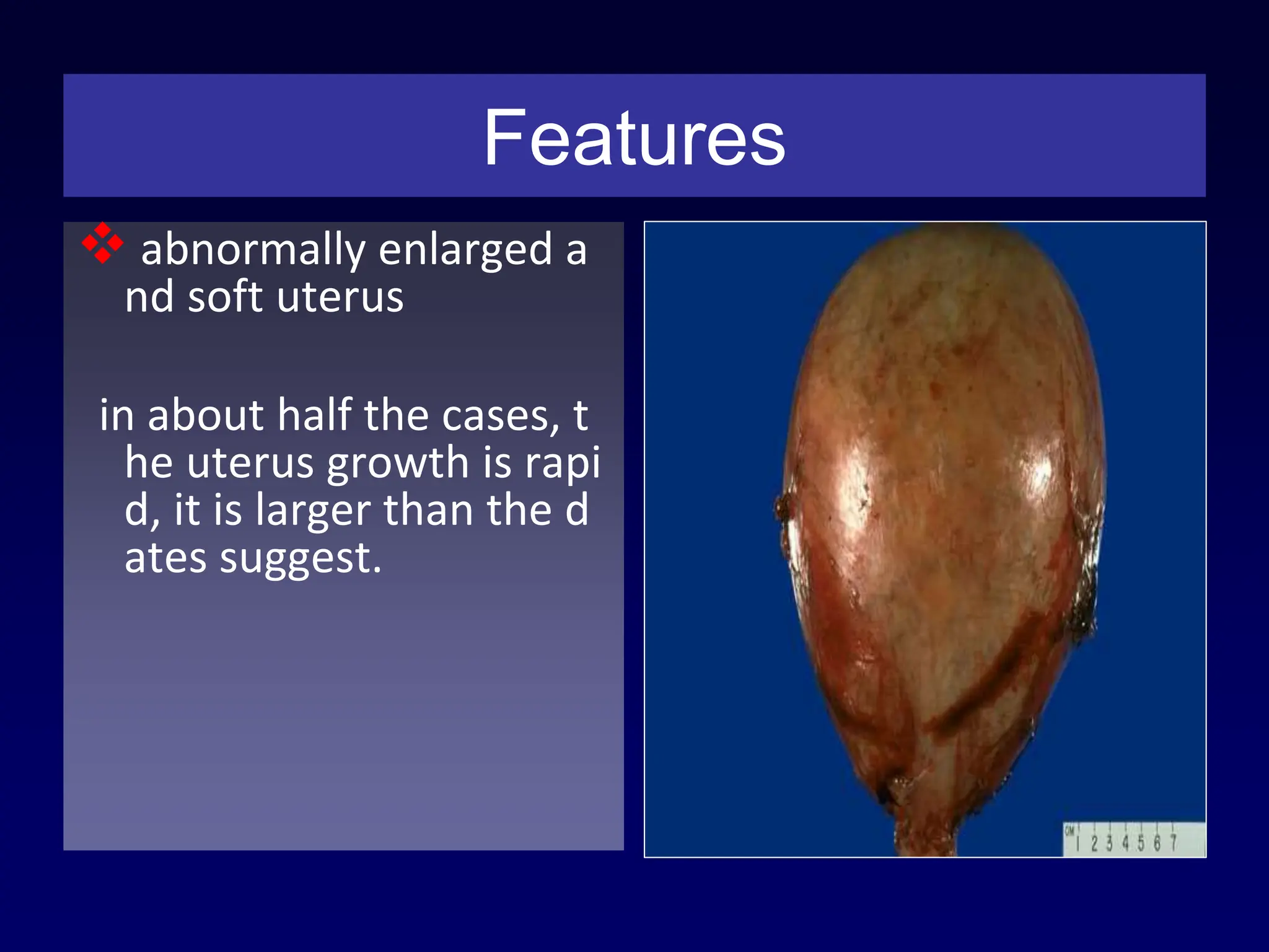 Gestational Trophoblastic Disease - Obstetrics | PPTX