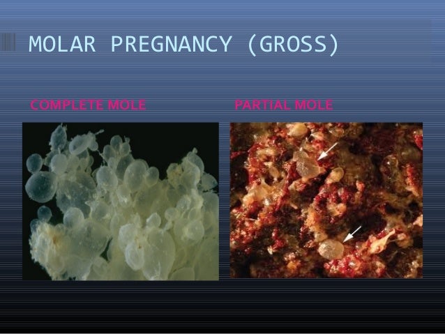 Gestatinal trophoblastic diseases by Dr ekram