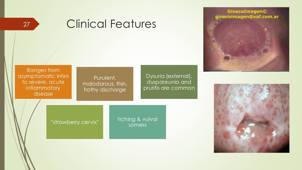 genital infection in gynecology
