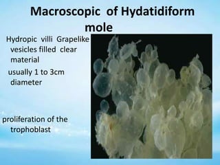 Gestational trophoblastic disease)class.ppt