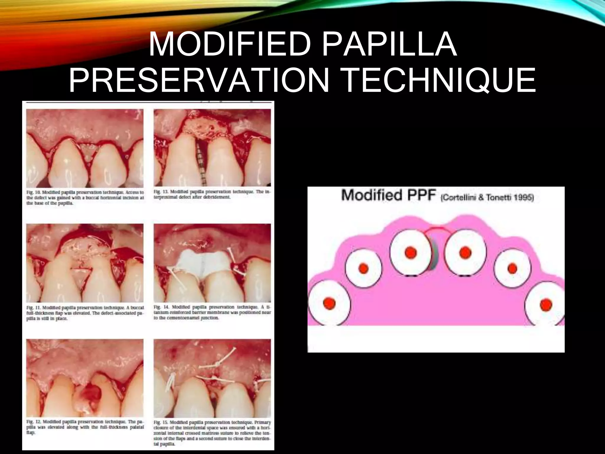 Guided tissue regeneration | PPTX