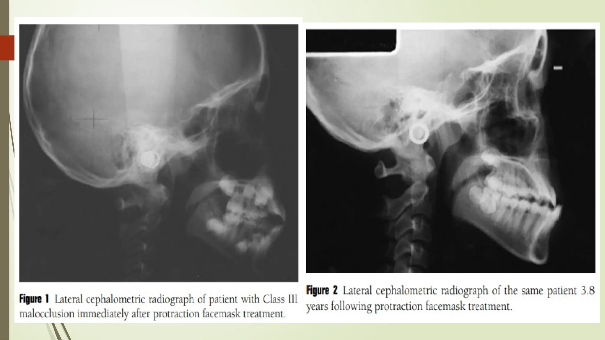 Treatment timing using GTRV in class 3 .pptx
