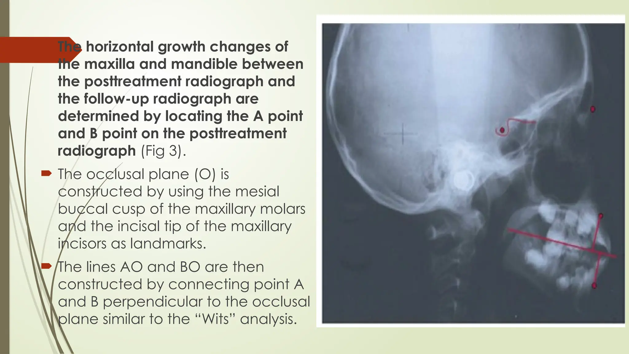 Treatment timing using GTRV in class 3 .pptx