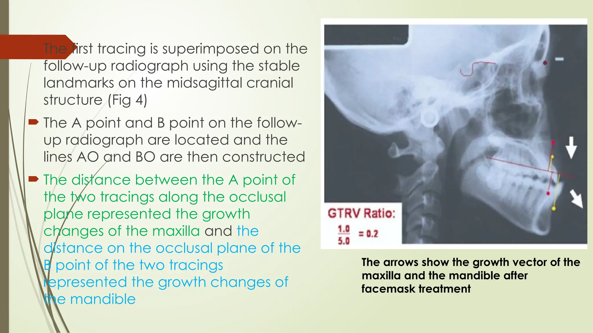 Treatment timing using GTRV in class 3 .pptx