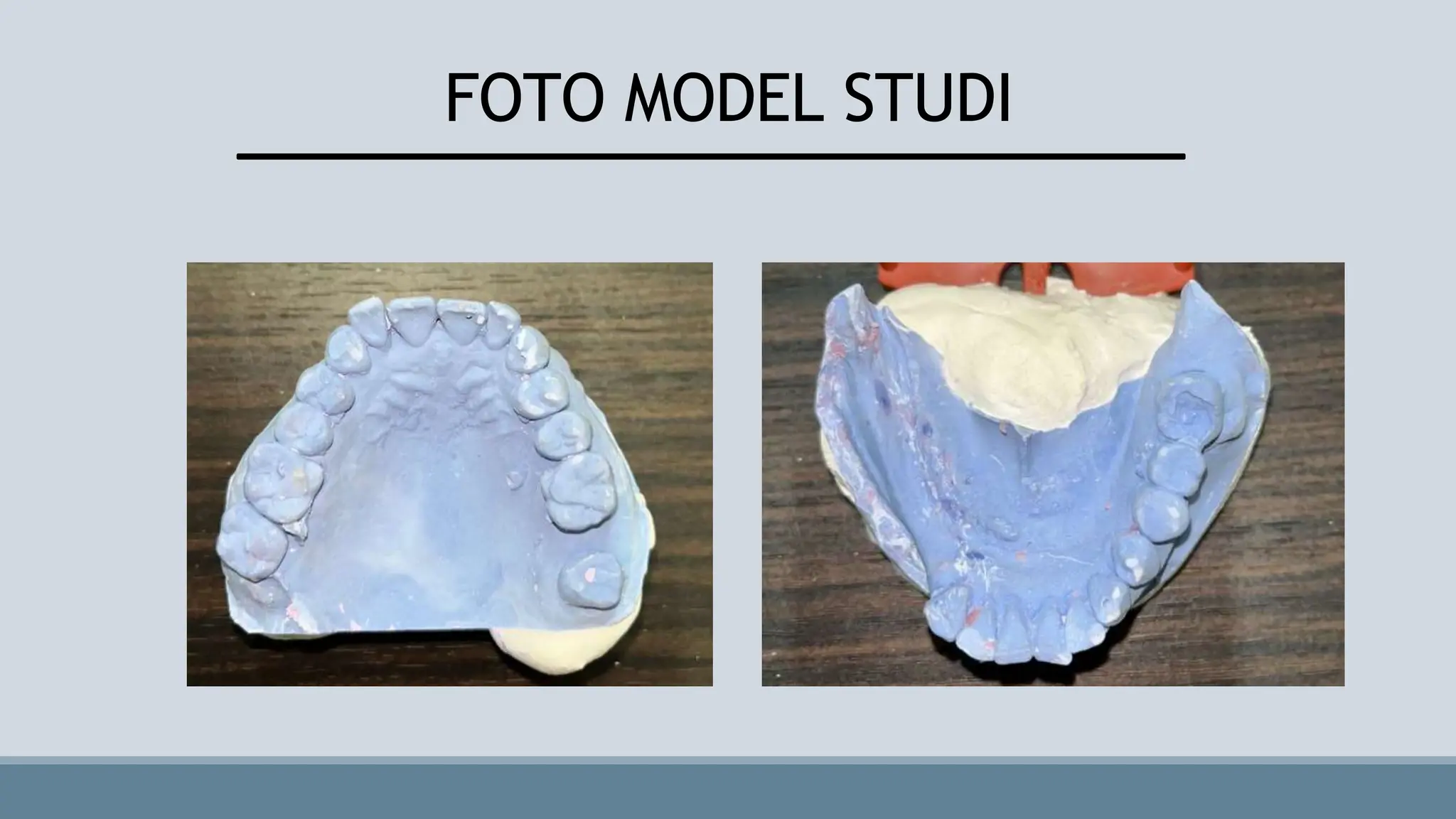metal frame denture unilateral design using rpa | PPTX
