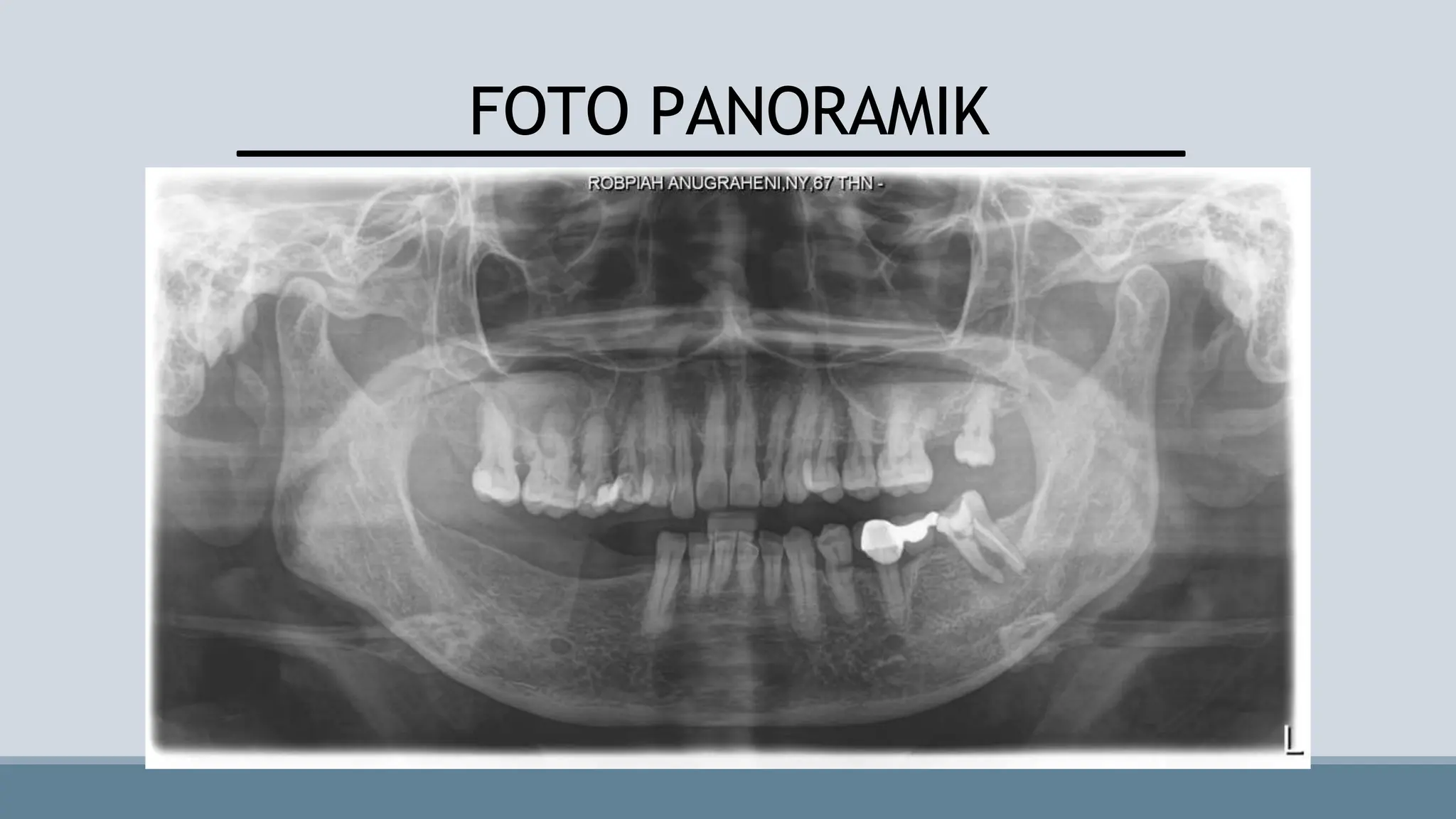 metal frame denture unilateral design using rpa | PPTX