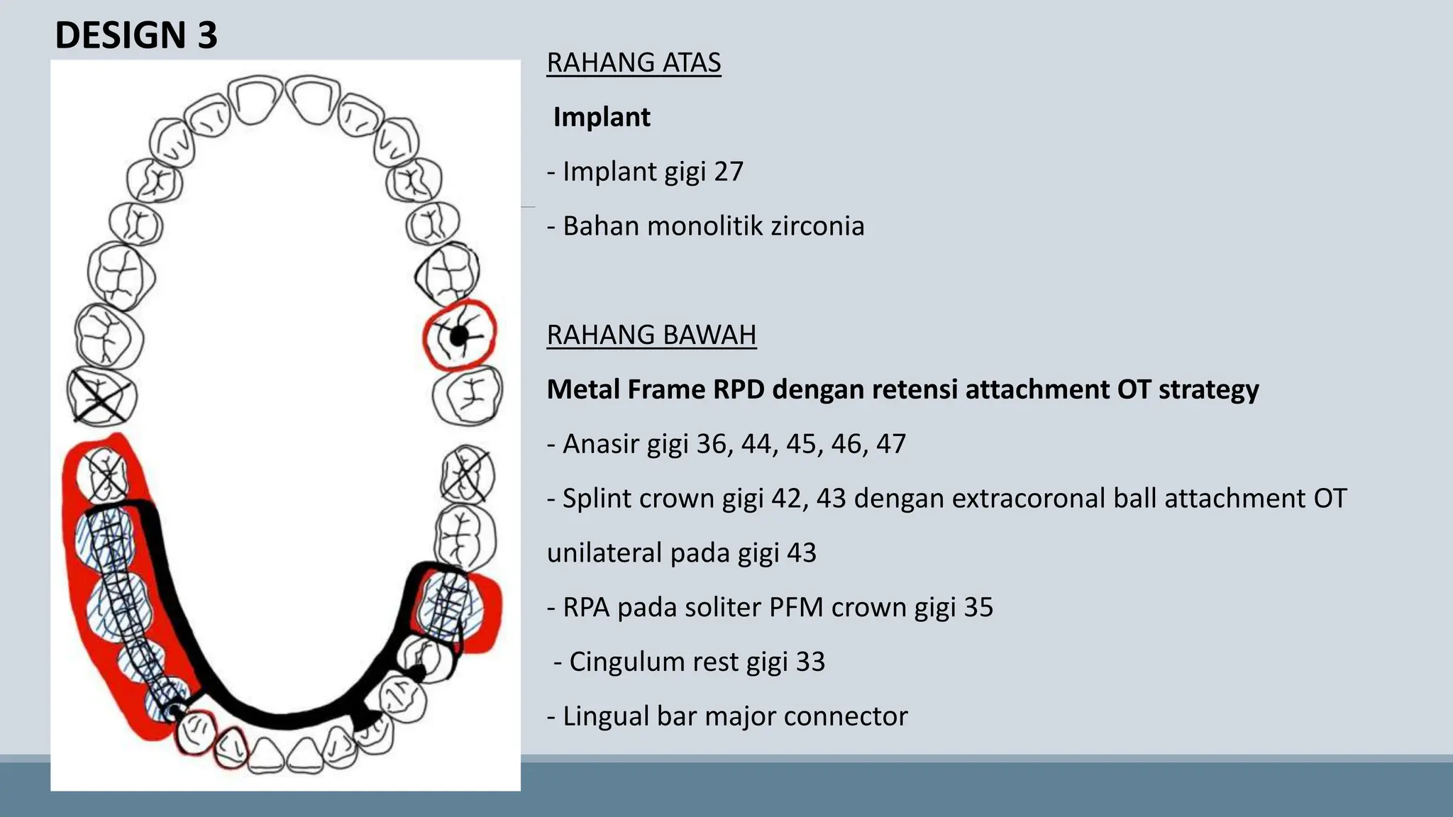 metal frame denture unilateral design using rpa | PPTX