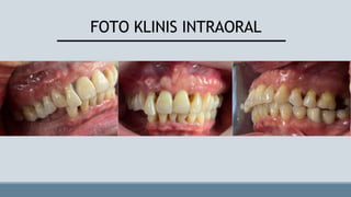 metal frame denture unilateral design using rpa | PPTX