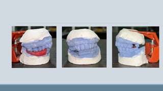 metal frame denture unilateral design using rpa | PPTX
