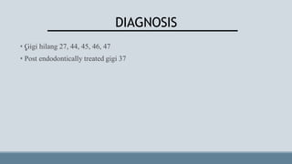 metal frame denture unilateral design using rpa | PPTX