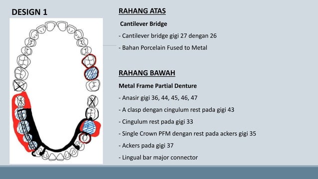 metal frame denture unilateral design using rpa | PPTX