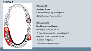metal frame denture unilateral design using rpa | PPTX