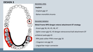 metal frame denture unilateral design using rpa | PPTX