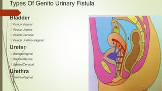 urinary tract fistula | PPTX