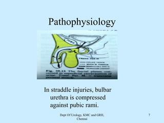 Gu trauma- urethra- initial management | PDF