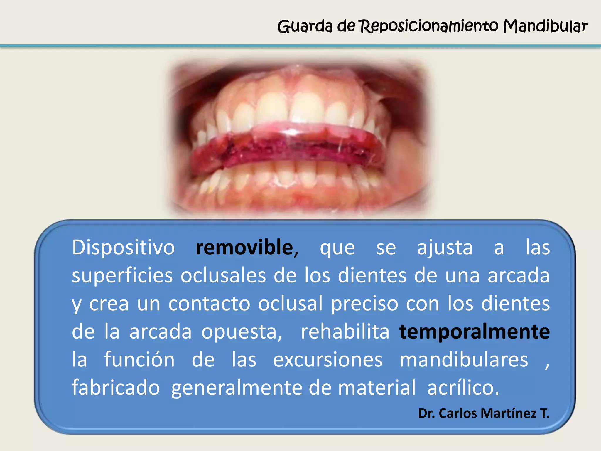 Guarda Oclusal | PPTX