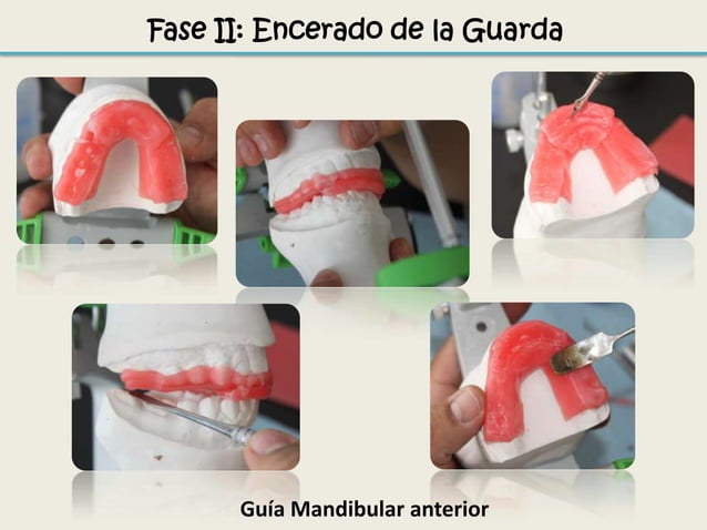 Guarda Oclusal | PPTX
