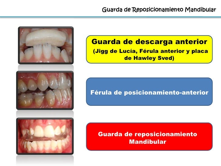 Guarda Oclusal