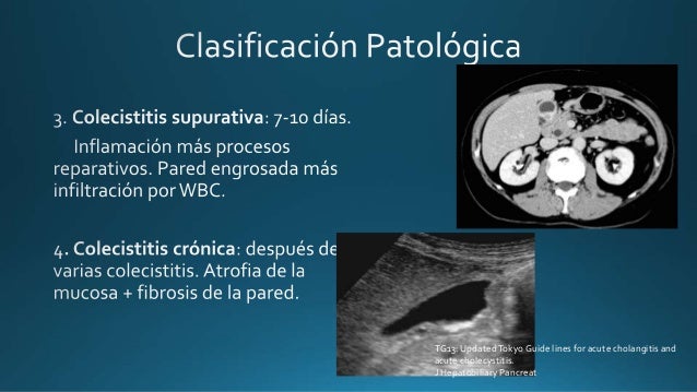 Guías de tokio para colecistitis y colangitis