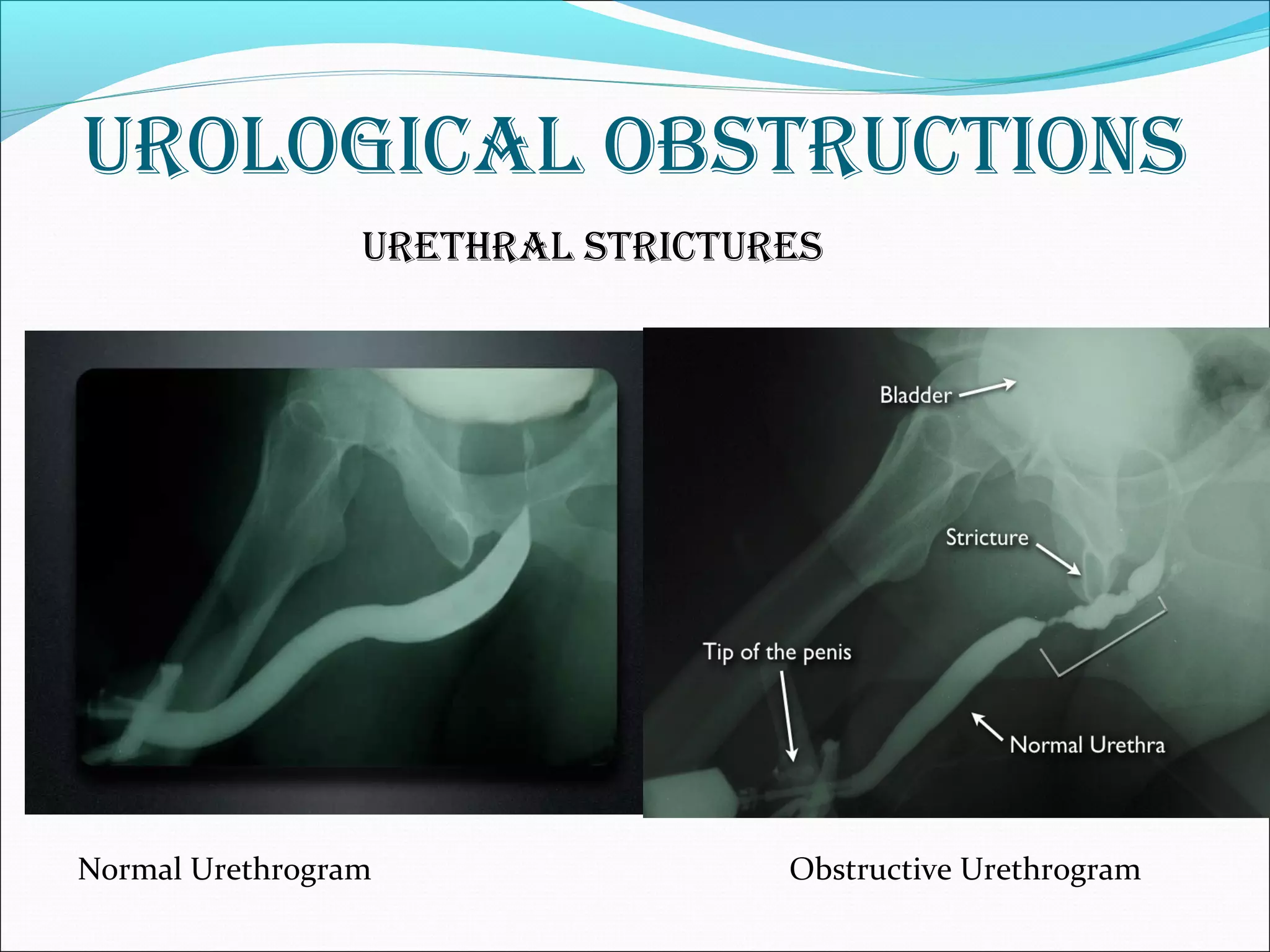 genitourinary disorders (medical surgical nursing) | PPT