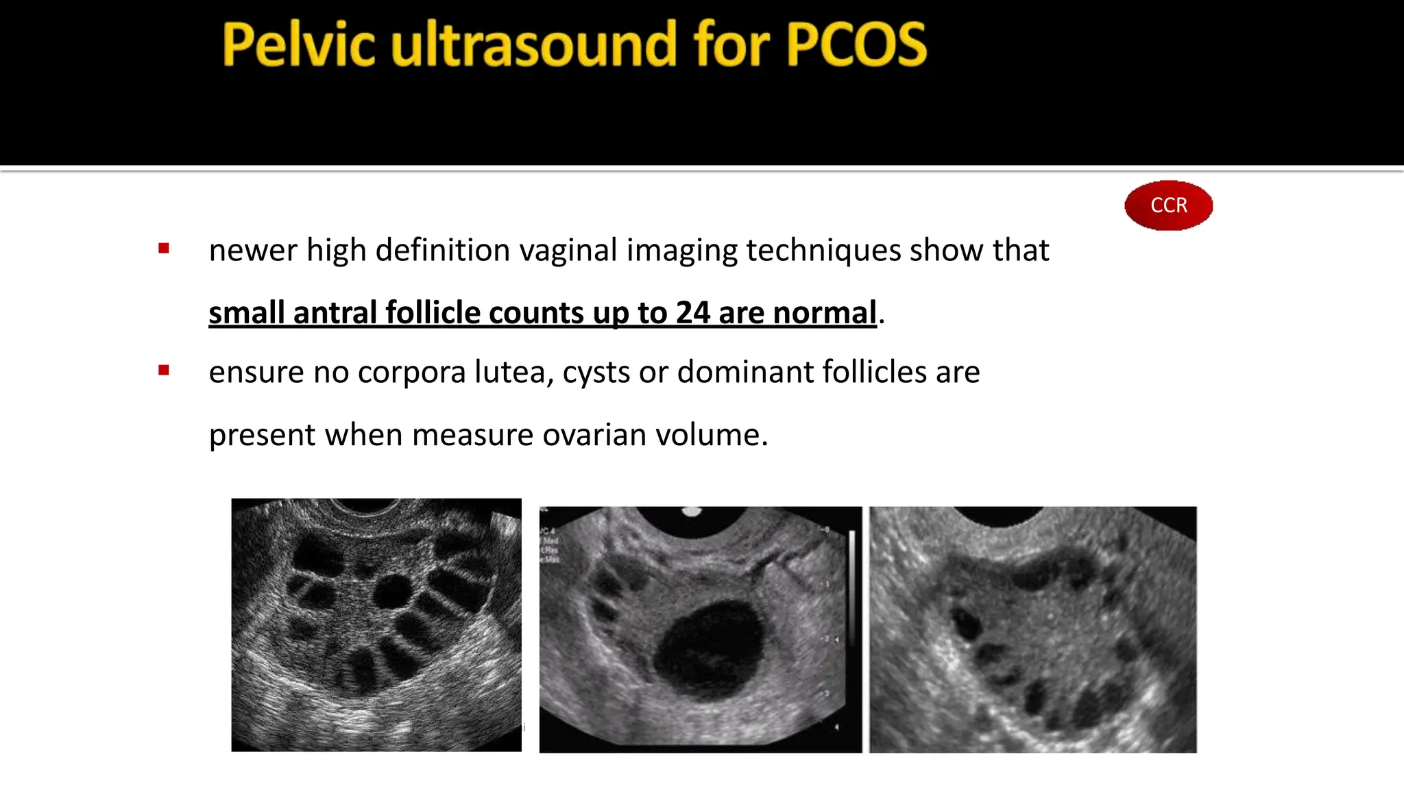 2023 recommendations for Adolescent PCOS.pptx