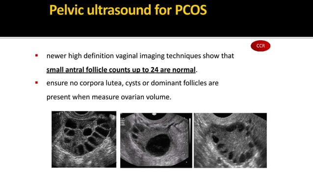 Adolescent PCOS 2023.pptx