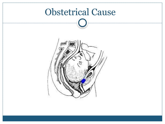 GENITO-URINARY FISTULA - TYPES, CAUSES, S/S, DIAGNOSIS, TESTS .pptx ...