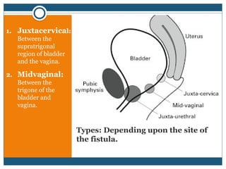 GENITO-URINARY FISTULA - TYPES, CAUSES, S/S, DIAGNOSIS, TESTS .pptx