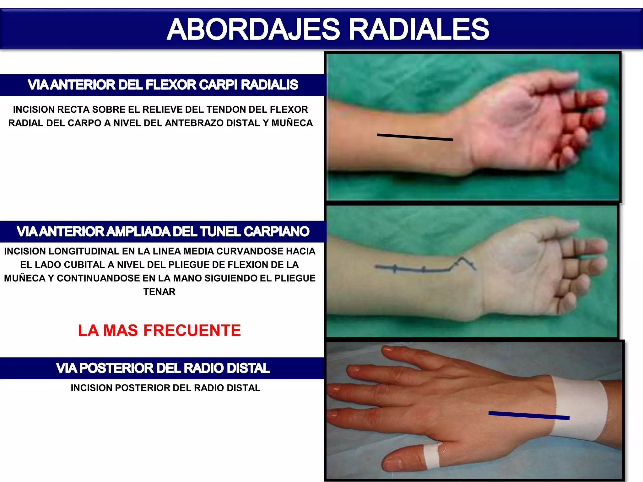 ESSALUD - GUIA CLINICA DE PRACTICA MEDICA DE RADIO DISTAL EN ADULTOS | PPTX