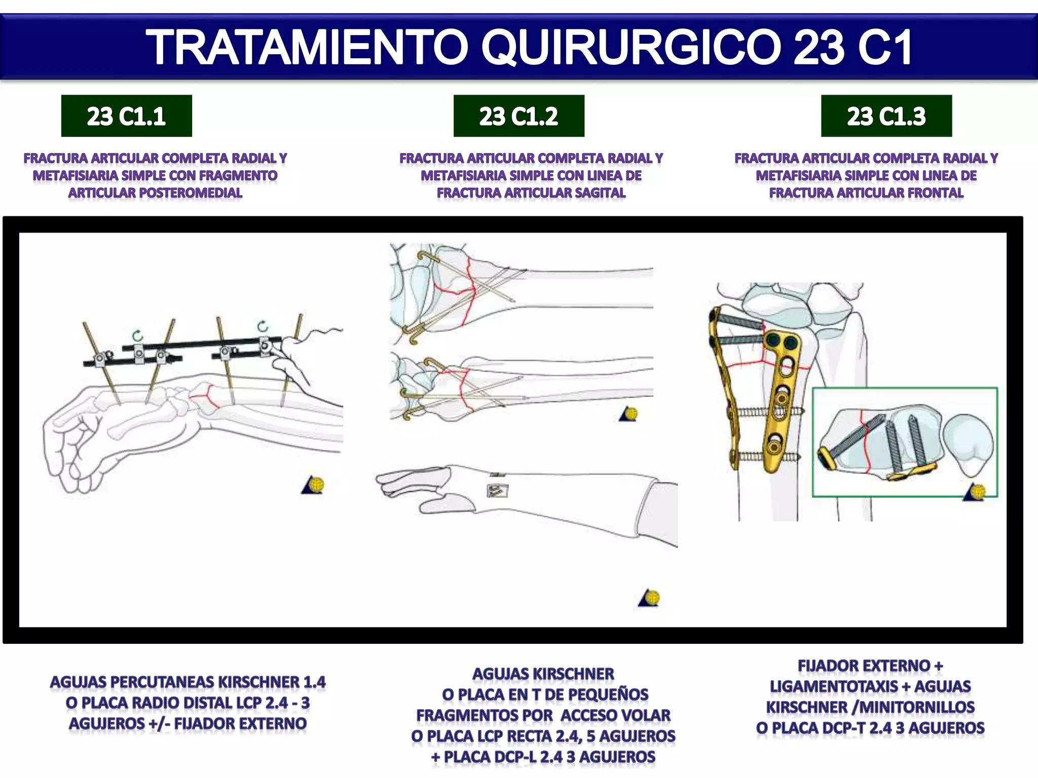 ESSALUD - GUIA CLINICA DE PRACTICA MEDICA DE RADIO DISTAL EN ADULTOS | PPTX