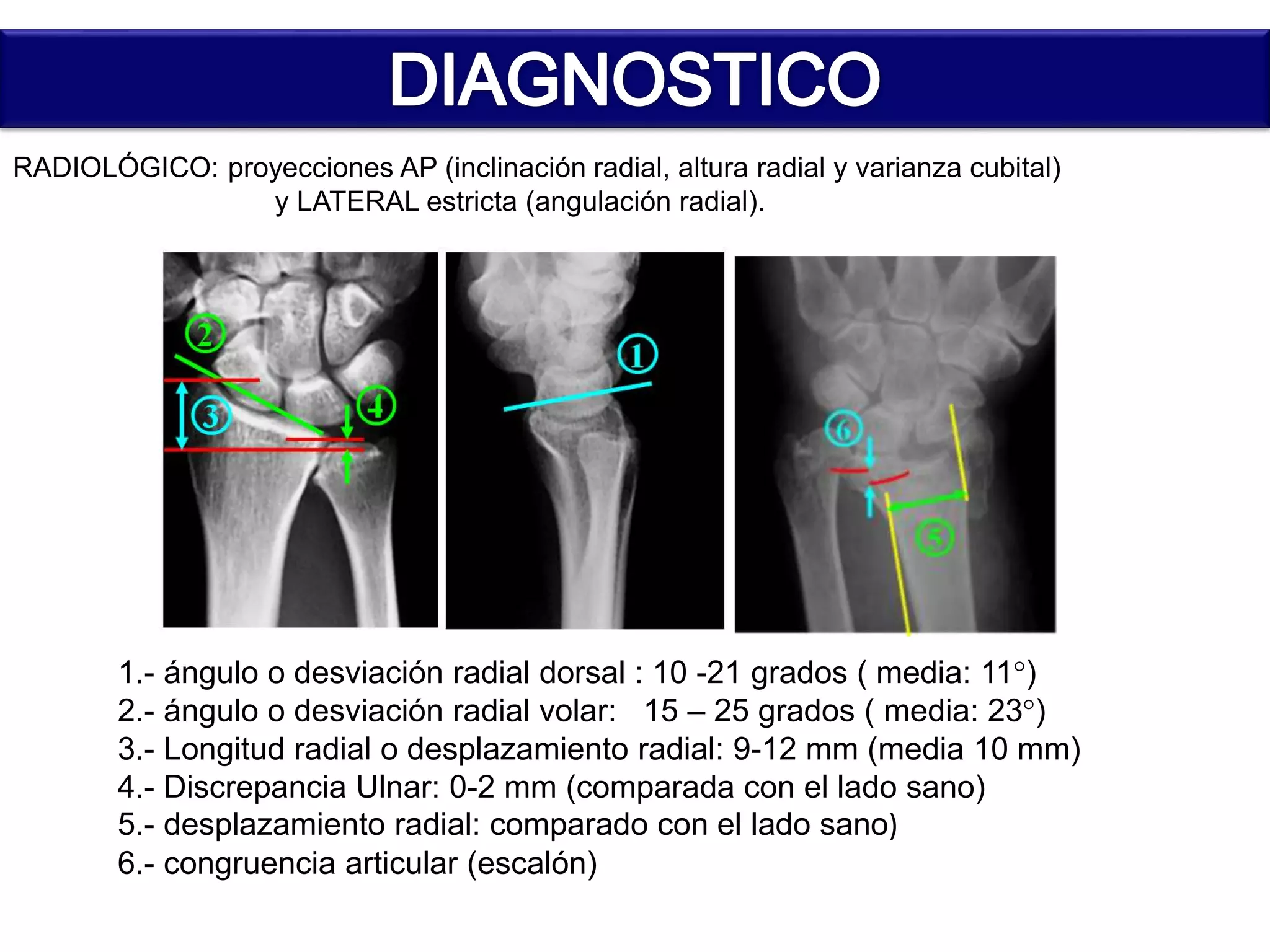 ESSALUD - GUIA CLINICA DE PRACTICA MEDICA DE RADIO DISTAL EN ADULTOS | PPTX
