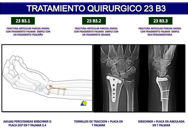 ESSALUD - GUIA CLINICA DE PRACTICA MEDICA DE RADIO DISTAL EN ADULTOS | PPTX