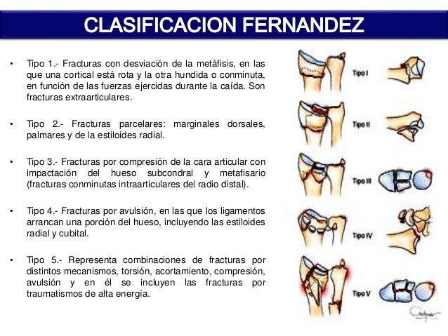 ESSALUD - GUIA CLINICA DE PRACTICA MEDICA DE RADIO DISTAL EN ADULTOS