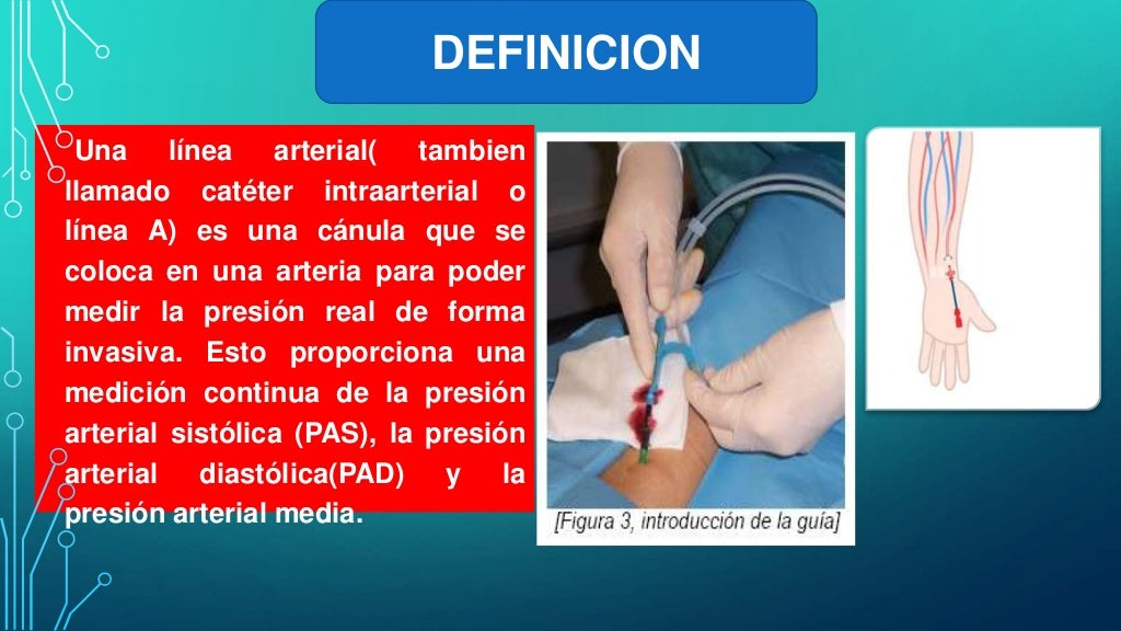 GUIA DE COLOCACION DE LINEA ARTERIAL.pptx